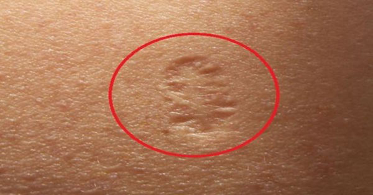 Do You Know The Truth Behind The Small Scar On The Upper Left Arm And ...