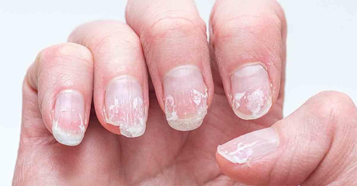 Rippled fingernails reveal secrets of possible d.isease - Wake Up Your Mind