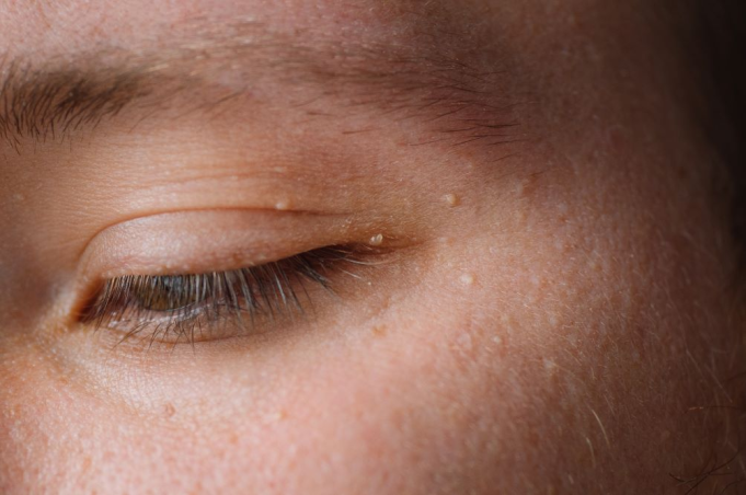 If You Have These Tiny, White Bumps on Your Face, Don’t Try to Remove ...