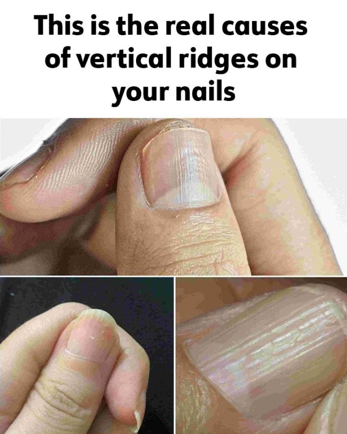 Understanding the Real Causes of Vertical Ridges on Your Nails - Wake ...