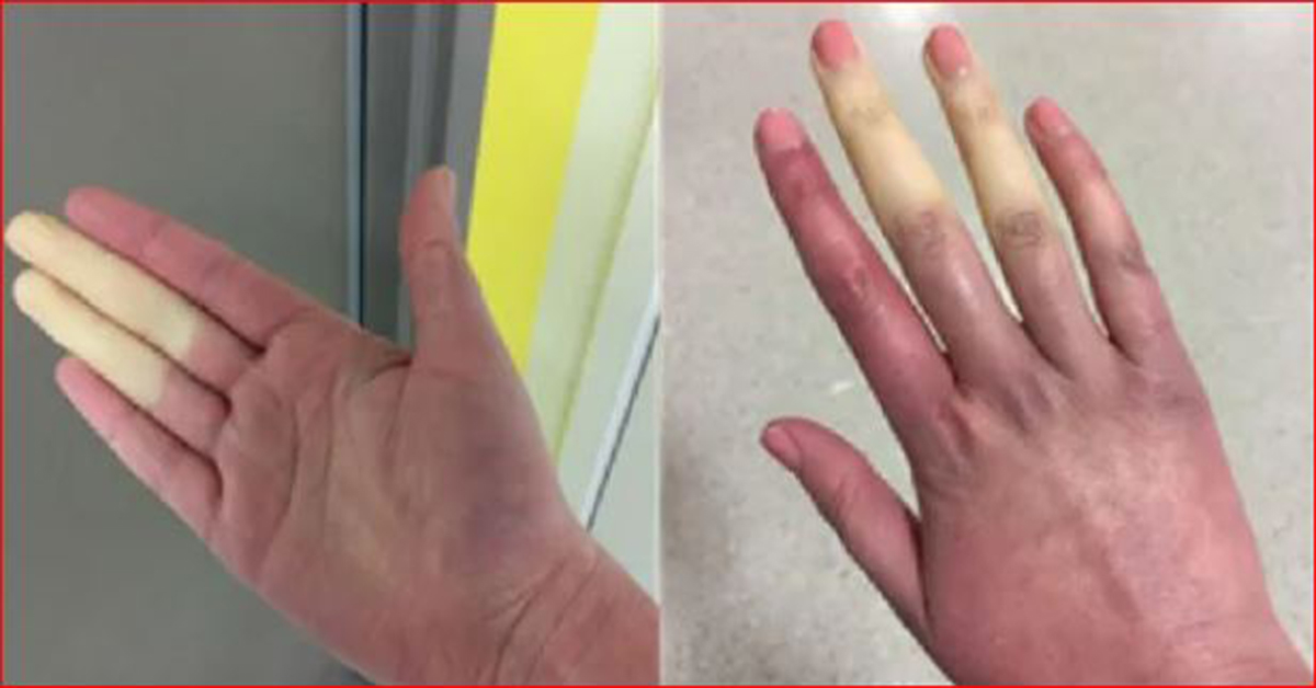 What it actually means if one of your fingers turns white when it’s ...