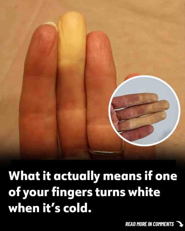What it actually means if one of your fingers turns white when it’s ...