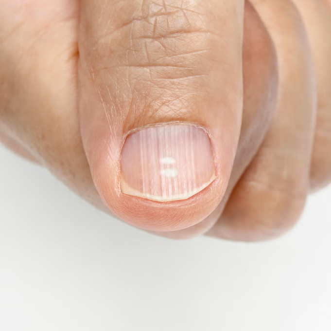 Understanding the Real Causes of Vertical Ridges on Your Nails - Wake ...