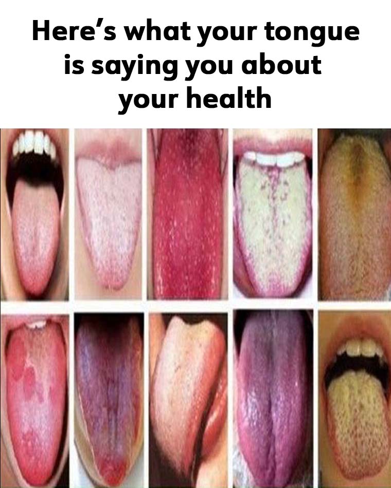 What Your Tongue Can Tell You About Your Health: 5 Signs You Shouldn’t ...